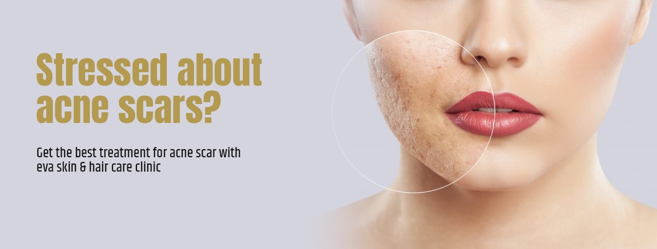 Best Pimples, Skin and Hair Treatment In Pune
