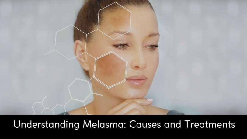Understanding Melasma: Causes and Treatments