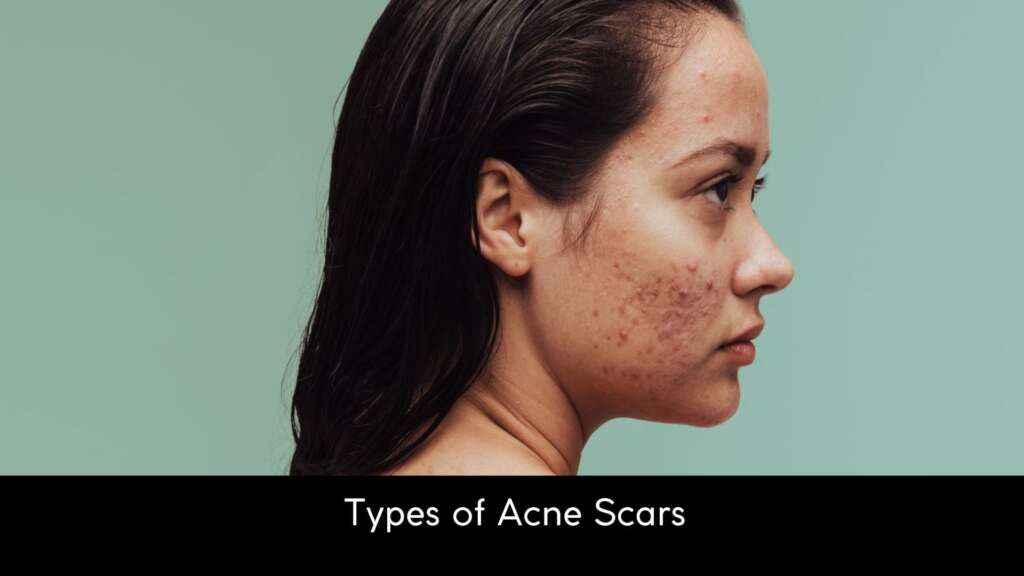 Types of Acne Scars: How to Identify and Treat Them