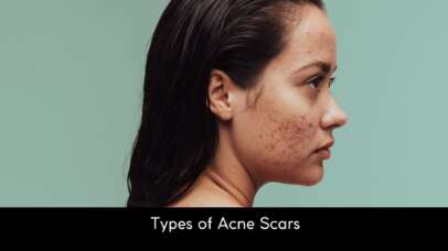 Types of Acne Scars: How to Identify and Treat Them
