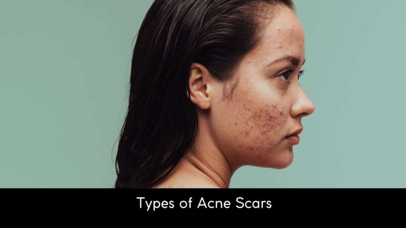 Types of Acne Scars: How to Identify and Treat Them