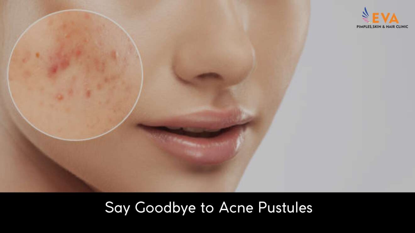Say Goodbye to Acne Pustules: Expert Tips & Treatment