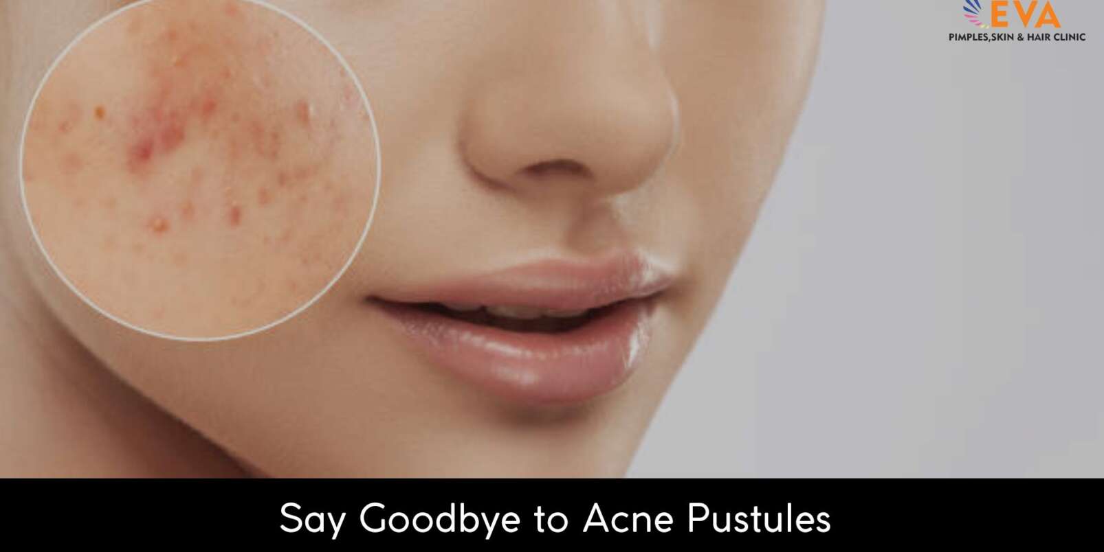 Acne Pustules - Eva - Pimples, Skin & Hair Clinic