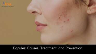Papules: Causes, Treatment, and Prevention | EVA