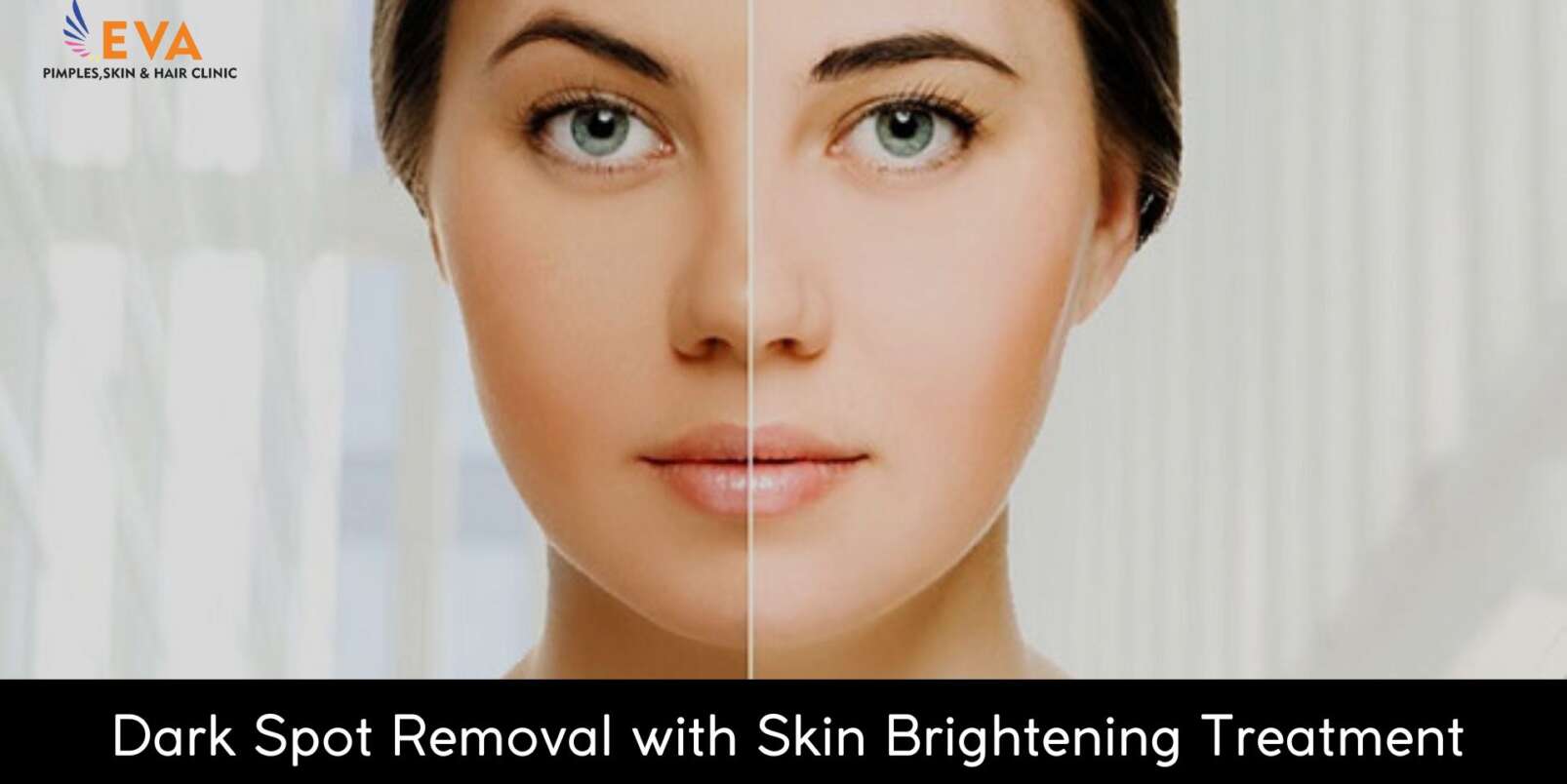 Dark Spot - Eva - Pimples, Skin & Hair Clinic