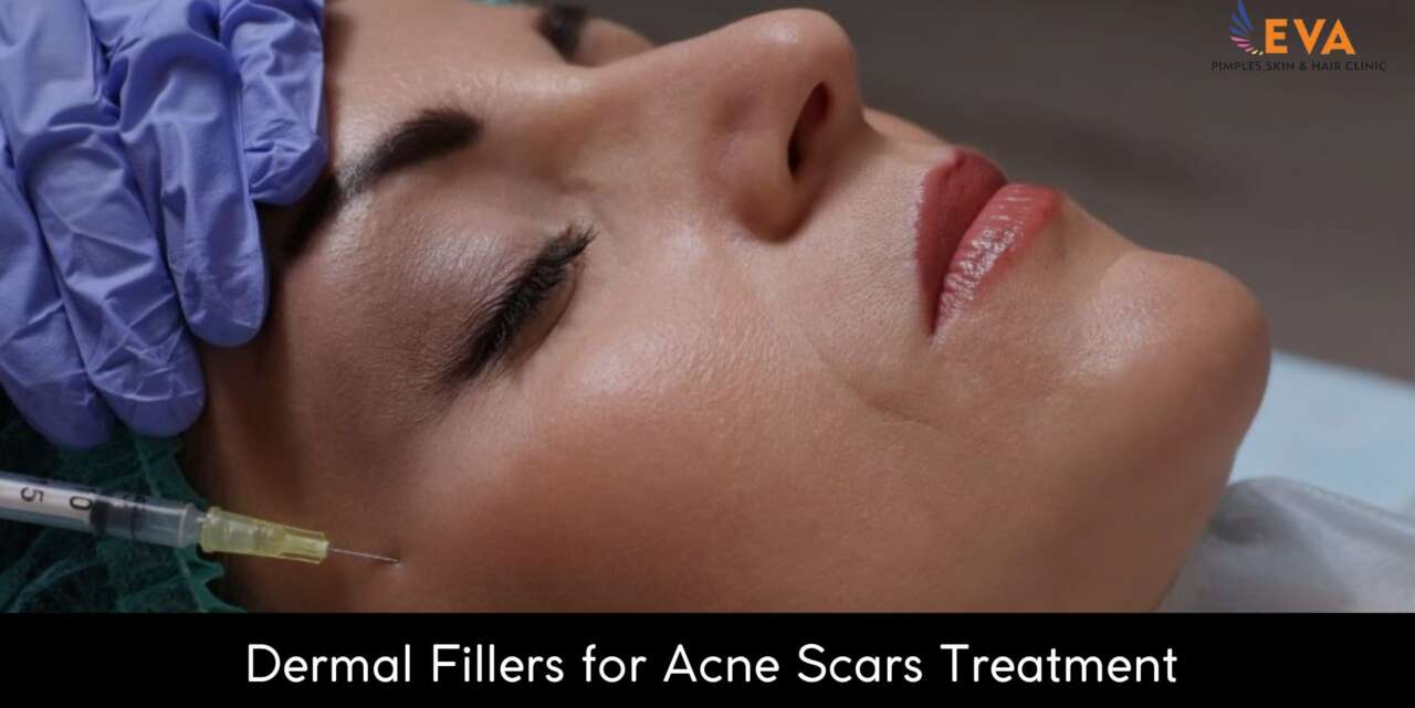 Acne Scars - Eva - Pimples, Skin & Hair Clinic
