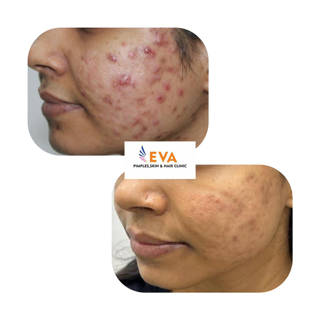 Best Acne Treatment Results - Eva - Pimples, Skin & Hair Clinic