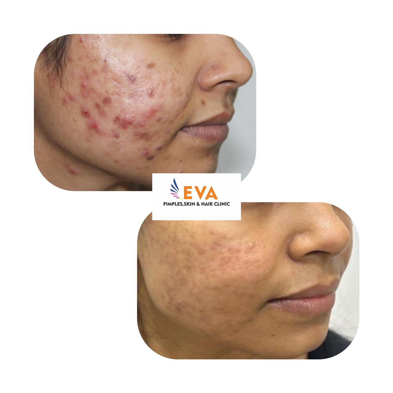 Best Acne Scar Results - Eva - Pimples, Skin & Hair Clinic