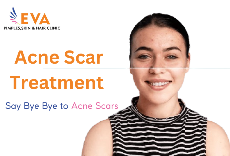 Acne Scar Treatment in Pune - Eva Skin Clinic, Wakad