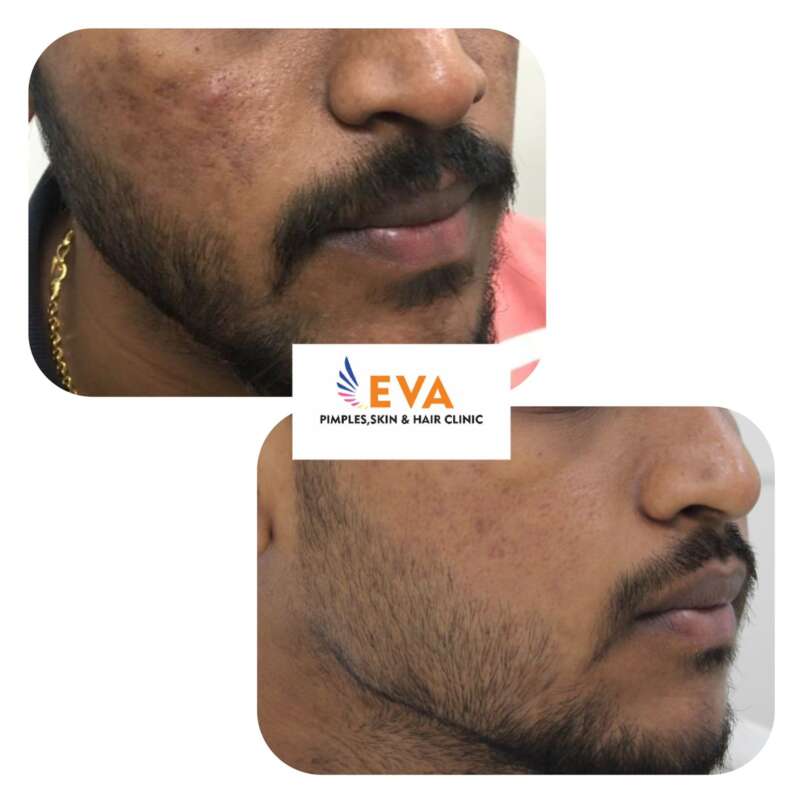 Best Acne Scar Results - Eva - Pimples, Skin & Hair Clinic