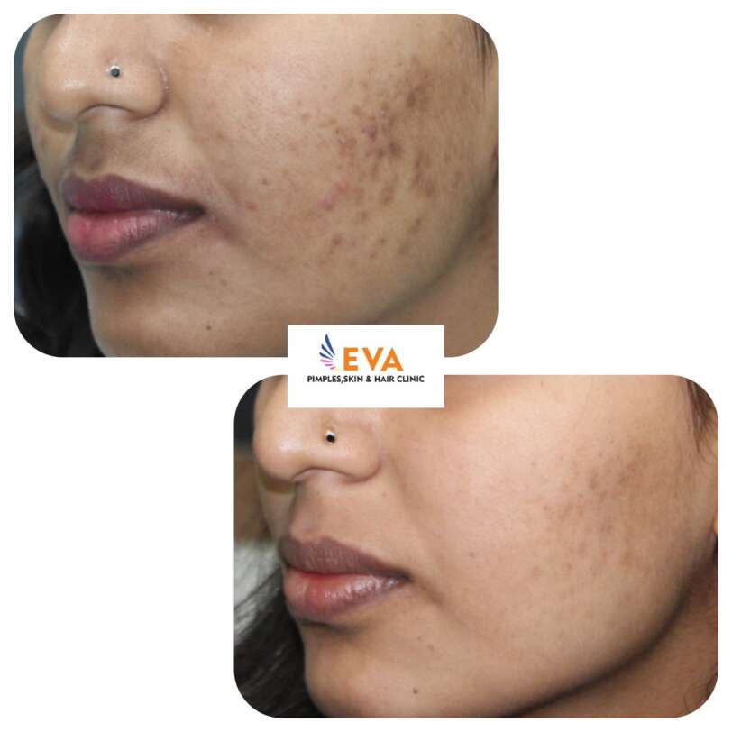 Best Acne Scar Results - Eva - Pimples, Skin & Hair Clinic