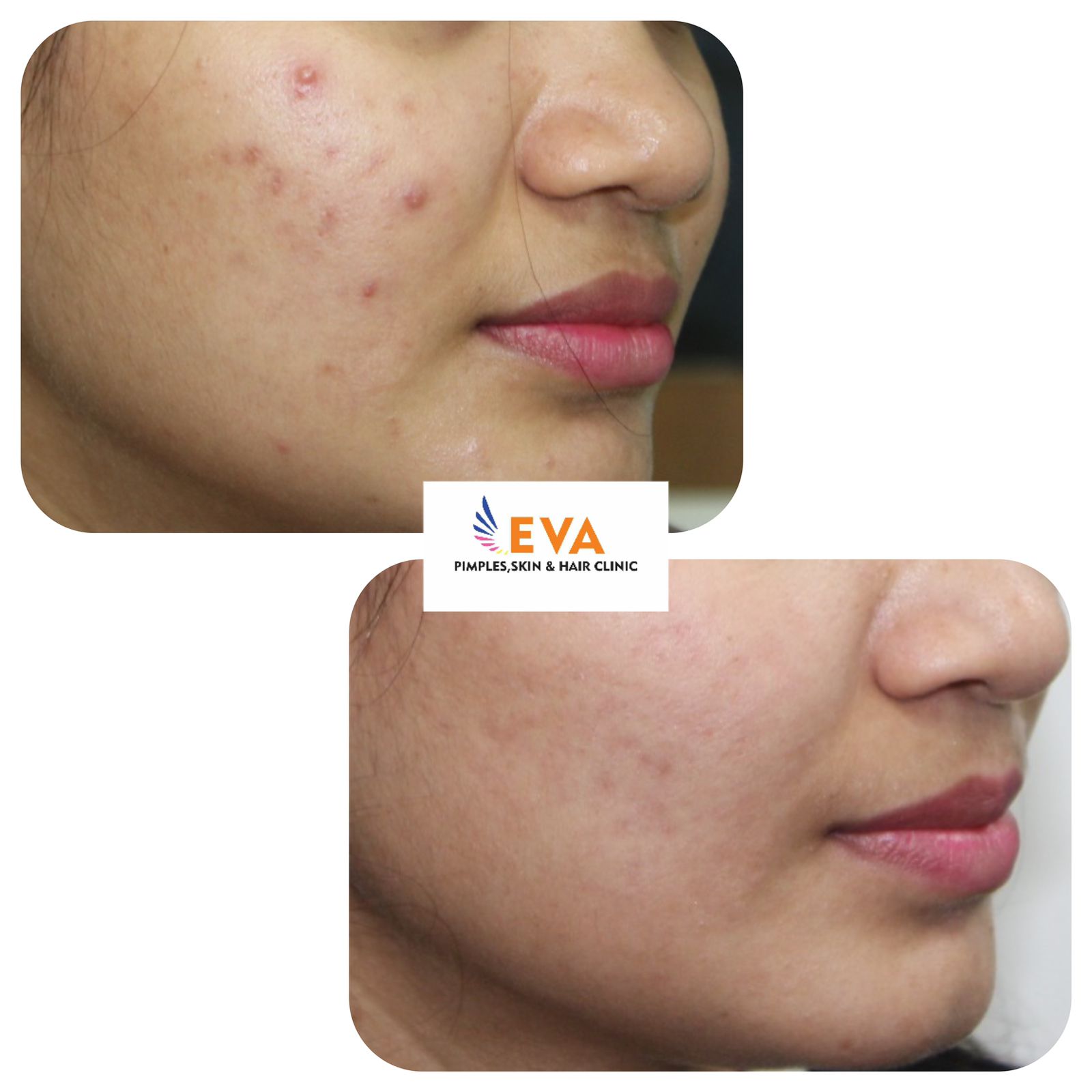 Best Acne Scar Results - Eva - Pimples, Skin & Hair Clinic